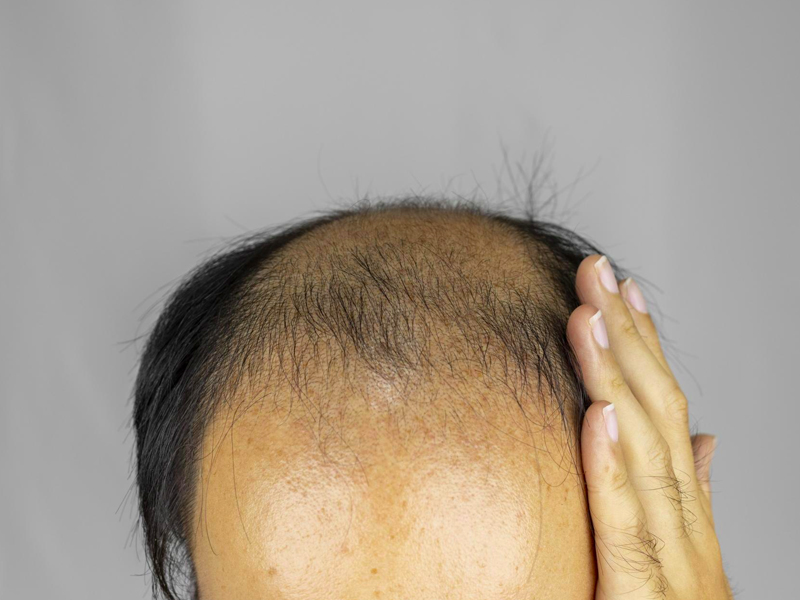 盤點頭髮越來越少的 6 個原因 (BOLDBOX)