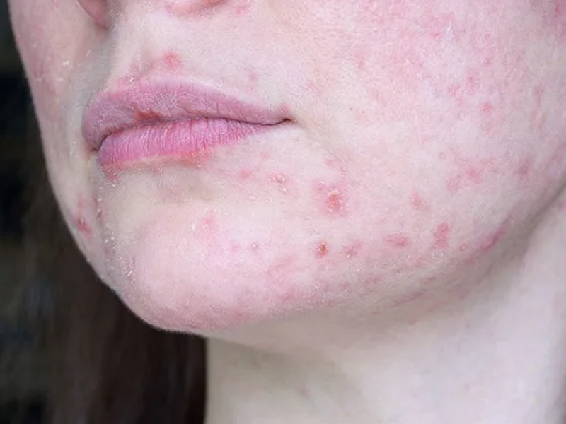 R: 日本「蘋果病」大爆發 (BOLDBOX)